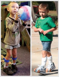 A New Way Of Thinking About AFO’s – Spasticity Series #6 – KAREN PAPE, MD